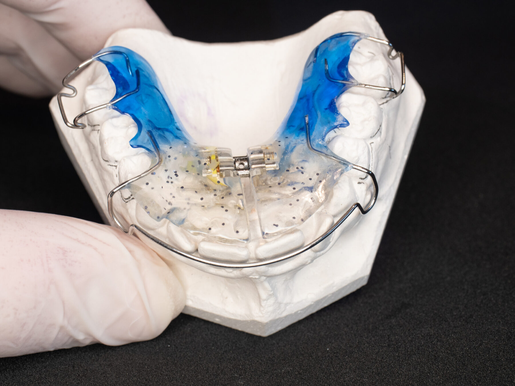 What Are Orthodontic Appliances Used For? | Mt. Airy